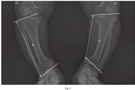 Radiograph Showing The Method Of Measuring The Lengths Of