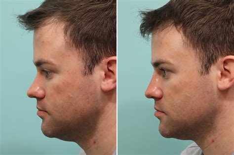 Liquidnon Surgical Rhinoplasty In Virginia And Maryland