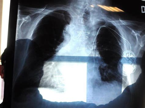 Cancro Ai Polmoni Individuato Il Punto Debole è Nel Motore Che Lo