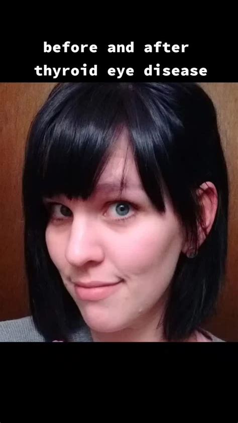 Hyperthyroidism Before And After Hyperthyroidism Symptoms Treatment