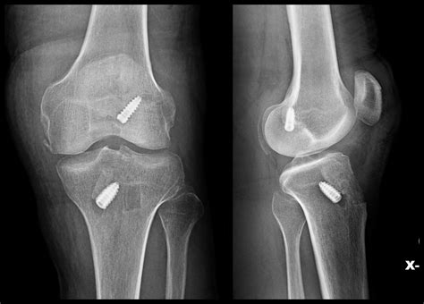 ACL Reconstruction BTB Autograft