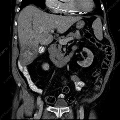 Gallstones Ct Scan Stock Video Clip K002 9515 Science Photo Library