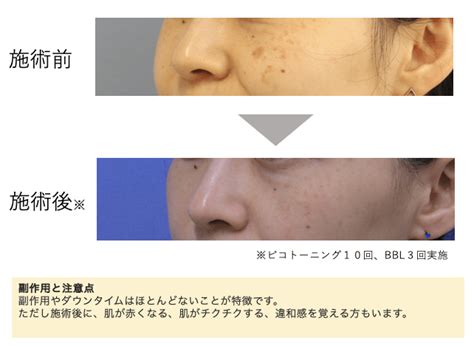 ピコトーニング 肝斑（かんぱん）・くすみ、毛穴、たるみ治療におすすめ 笹塚駅前こたろ形成皮ふ科クリニック 京王線「笹塚」駅すぐ