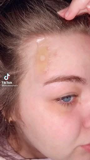 Easy Acne Treatment Artofit