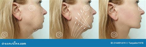 Woman Double Chin Saggy Correction Before And After Treatment Facelift