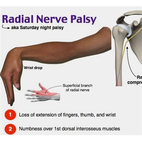 Pisces Healthcare Radial Nerve Palsy Splint Dynamic Wrist 44 Off
