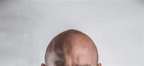 Почему рак кожи связан с облысением Наука и жизнь