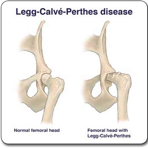Figure 1 From Legg Calvé Perthes Disease Semantic Scholar