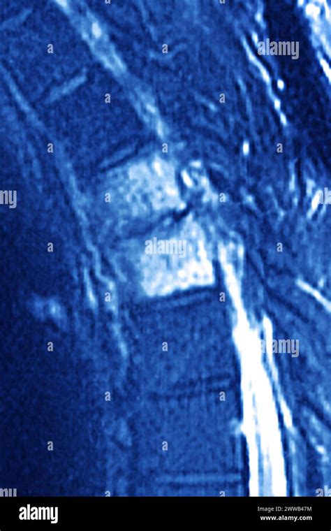 Vertebral Osteitis Inflammation Of The Bone Tissue Of Two Dorsal