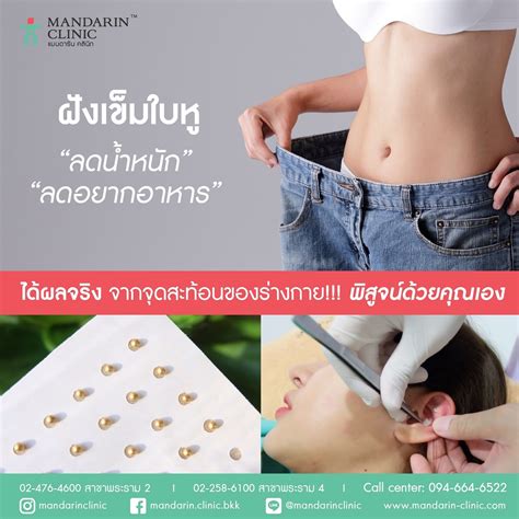 ฝังเข็มลดน้ำหนัก เป็นการใช้เข็มฝังเข็มเพื่อโน้มนำการทำงานของสมองและ
