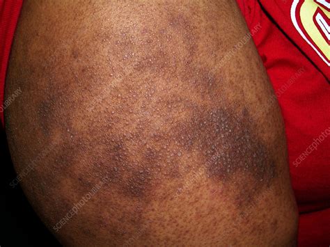 Papular Eczema Stock Image C0565478 Science Photo Library
