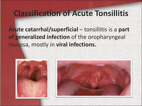 Acute Tonsillitis Pptx