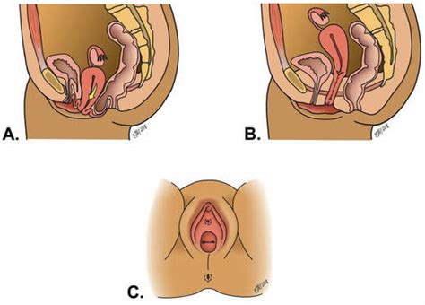 Colpocleisis
