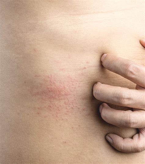 Liver Disease Skin Itching 7 Signs Of Fatty Liver On Skin