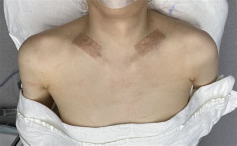 Plastic Surgery Case Study Reduction Of The Curved Asymmetric Clavicles In Shoulder