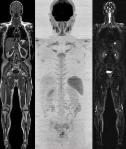 Benefits Of Whole Body MRI Aim Medical Imaging