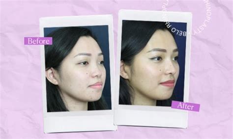 Rhinoplasty Nose Surgery Philippines Belo Medical Group