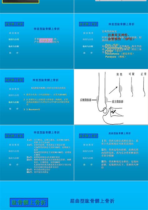 肱骨髁上骨折PPT模板 卡卡办公