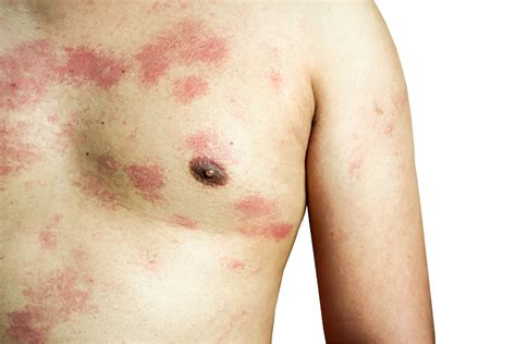 11 Doenças De Pele Mais Comuns Saiba Como Prevenir E Tratar