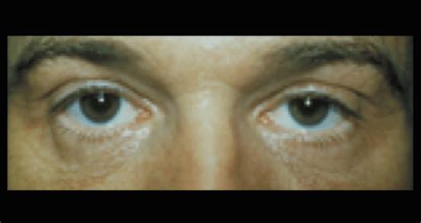 Blepharoplasty Eyelid Surgery Beeson Cosmetic Surgery