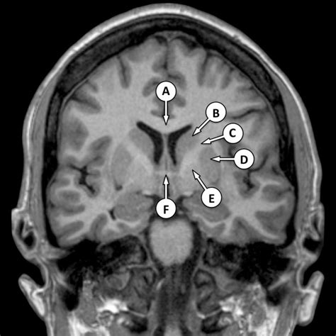 Basal Ganglia Mri At Raymond Porter Blog