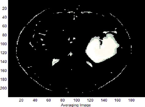 Figure 1 From Mri Image Segmentation Using Level Set Method And