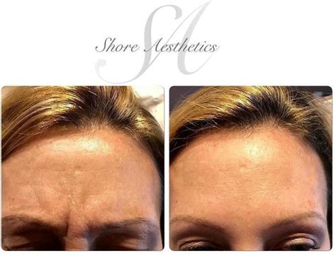 Botox In 11s Photo Facial Injections Info Prices Photos Reviews Qanda