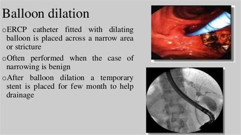 Procedure Of Ercp And T Tube Cholangiography