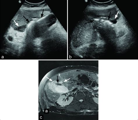 Safety And Efficacy Of Percutaneous Cholecystostomy For Emphysematous