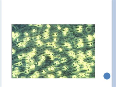 Trigeminal Neuralgia Ppt Brain And Nervous System Disorders Diseases And Conditions