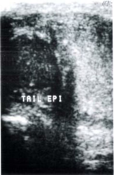 Usg Showing Enlarged And Hypoechoic Left Tail Of The Epididymis With