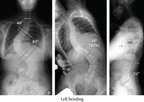 Case 1 Preoperative Radiographs From Left To Right Anteroposterior