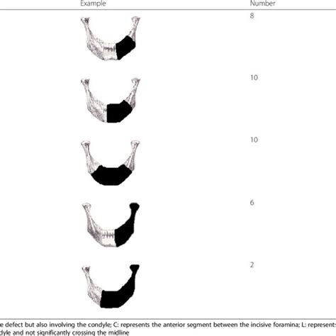 Characterization Of The Bony Defect As Per Hcl Classification
