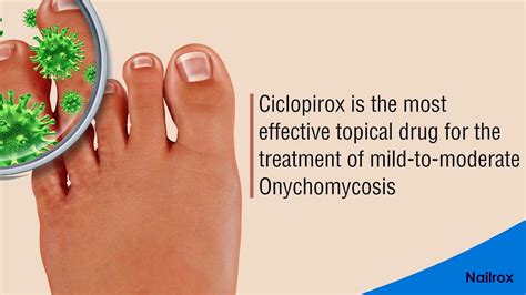 Exploring The Potential Of Ciclopirox Olamine Cream Uses And Side Effects