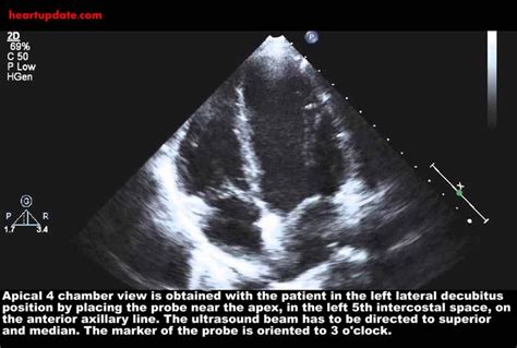 Echocardiography Apical 4 Chamber View Ap4ch