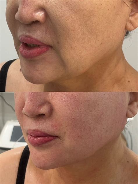 대구 이중턱 주름 탄력 리프팅 물광촉촉 피부관리 메디컬스킨케어전문센터 아미뷰티에서 예뻐지세요 ️ 네이버 블로그