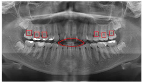 Xray Of Front Teeth