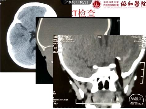 异物致儿童开放性颅脑损伤的诊治符三例报告 脑医汇