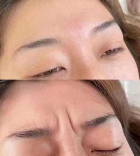 Mono Threads Facial Lifting Threads For Tightening The Skin