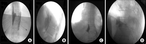 A Celiac Plexus Block Posteroanterior View Of Both Needles With The