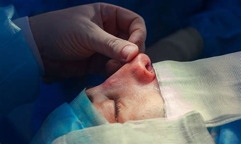 Botched Nose Job Meaning Marissa Koonce