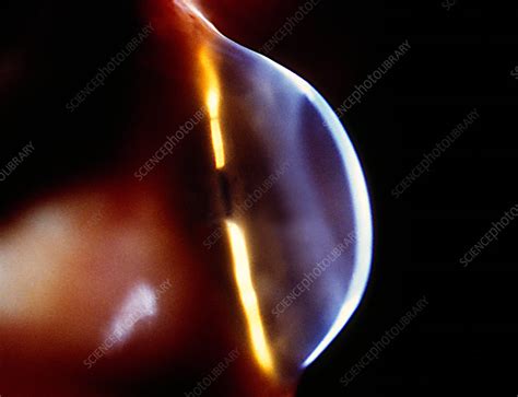 Cornea And Iris Slit Lamp Examination Stock Image C034 6876