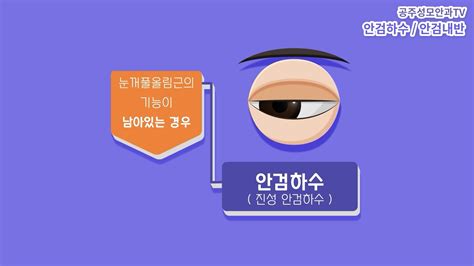 😀 안검하수 안검내반 공주성모안과 내눈바로알기 졸려보이는 눈은 다 안검하수인가요 진짜 안검하수와 가짜 안검하수가 뭔가요