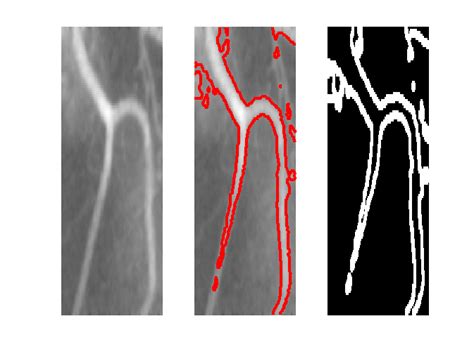 Matlab Contrast Enhancement Of An Image Using Neighbourhoood Stack