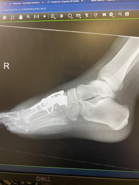 Hi Its Me Again Had My 6wk Checkup Rlisfrancclub
