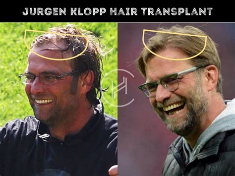 Jurgen Klopp Hair Transplant Hair Loss And Technical Analysis