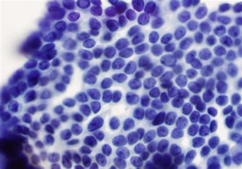 When Does Thyroid Cancer Spread
