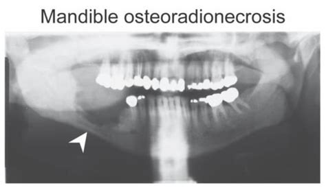 Osteosarcoma Jaw X Ray