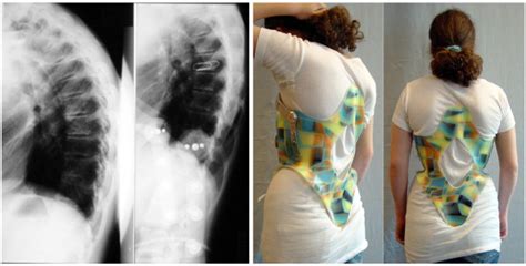 Another Patient With Good In Brace Correction In A Kyphologic™ Brace Download Scientific