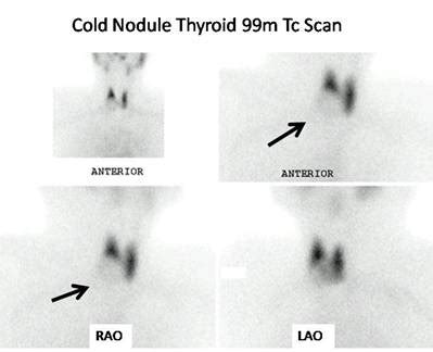 Thyroid Scan Cold Nodule